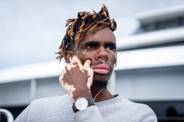 All You Need to Know About Vitiligo